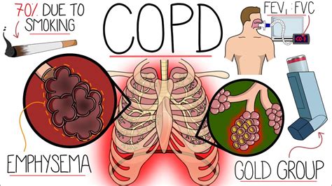 Understanding Chronic Obstructive Pulmonary Disease Copd Explained