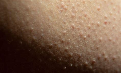 How To Get Rid Of Textured And Bumpy Skin Dermatologist Tips