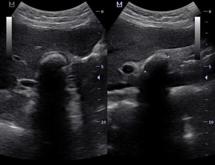Chronic Cholecystitis Ultrasound Wes Sign