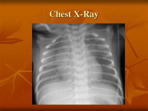 Ppt Transient Tachypnea Of The Newborn Ttn Powerpoint Presentation