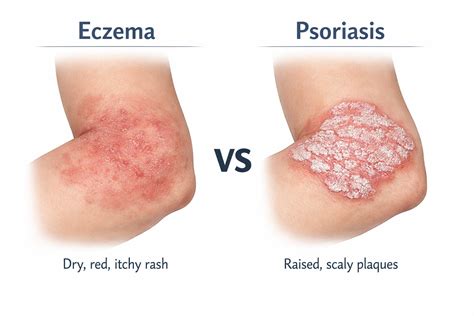 Eczema Vs Psoriasis Differences Symptoms And Care