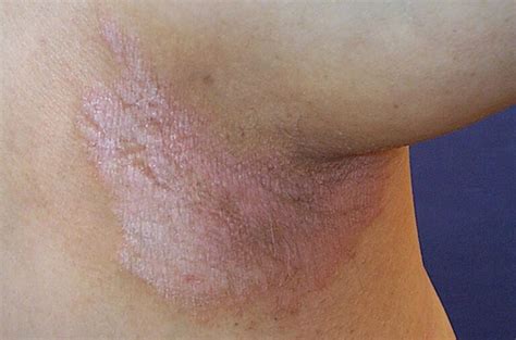 Treating Rashes At Home 13 Home Remedies Optinghealth