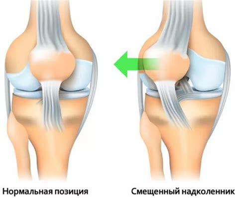 Спортивные травмы колена виды и методы лечения