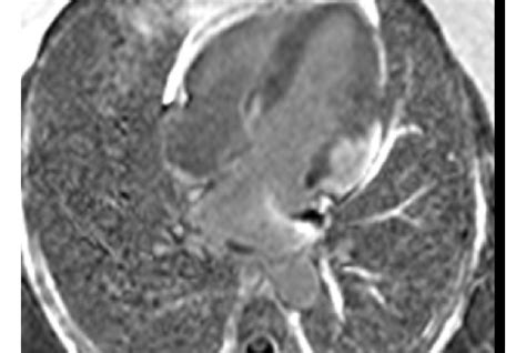 Delayed Contrast Psir Imaging Reveals Significant Subepicardial Download Scientific Diagram