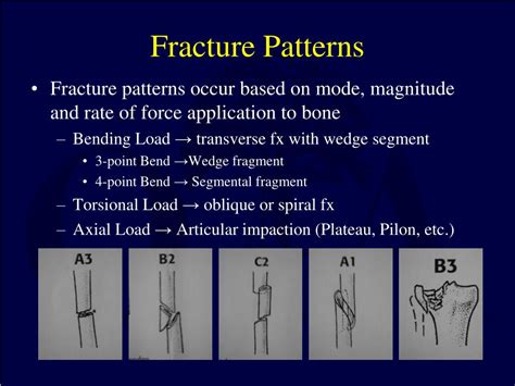 Ppt Basic Principles And Techniques Of Internal Fixation Of Fractures