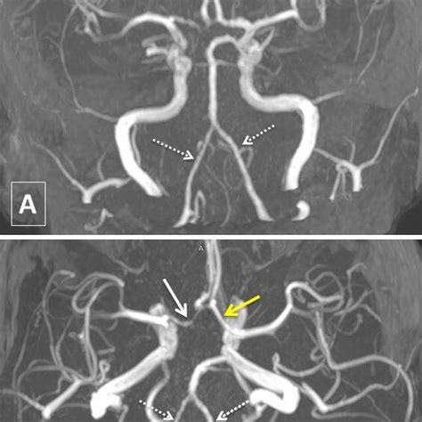 Ten Year Old Neurologically Free Female Patient On A Regular