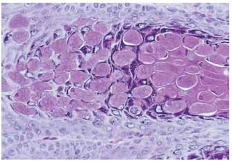Eyelid Inflammatory Lesions Simulating Neoplasms Ento Key