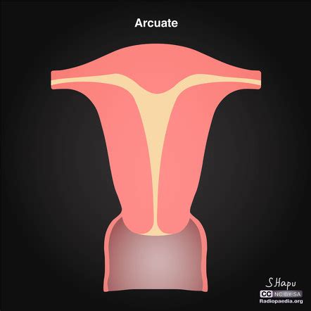 Arcuate Uterus Ultrasound Findings