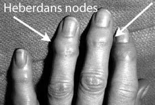 Heberden Nodes