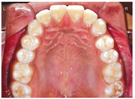 Andrews Six Keys To Occlusion Focus Dentistry