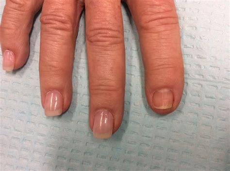 Onycholysis — Dr Dana Stern Dermatologist Nail Specialist