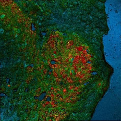 Lymph Metastasis Colorectal Ca Image Eurekalert Science News Releases