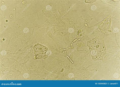 Pseudohyphae And Budding Yeast Cells In Patient Urine Royalty Free Stock Image Cartoondealer