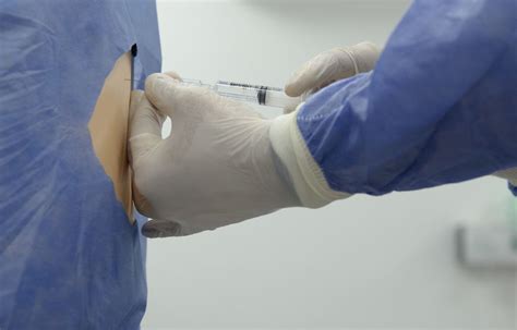Qué es la anestesia epidural y por qué revolucionó la medicina moderna Adaarc
