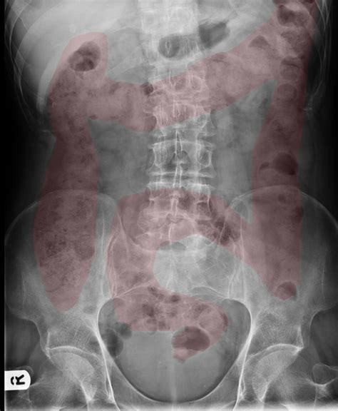 Full Stomach X Ray