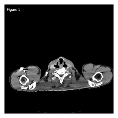Cardiovascular And Interventional Radiological Society Of Europe On
