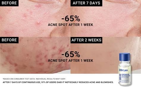 Salicylic Acid Acne Treatment Drying Lotion Beauty