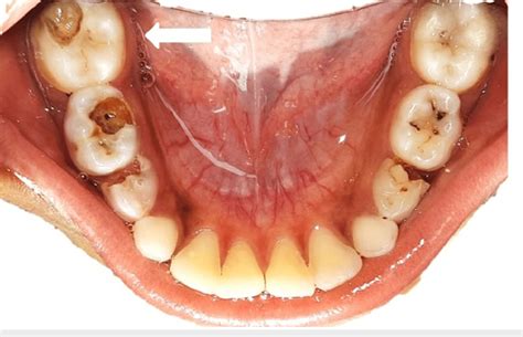 Pre Operative Intraoral Image Deep Occlusal Caries Associated With The
