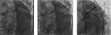 A Distal LM And Proximal LAD And Proximal LCX Lesion B Download Scientific