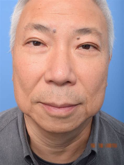 Upper And Lower Blepharoplasty Vip Plastic Surgery