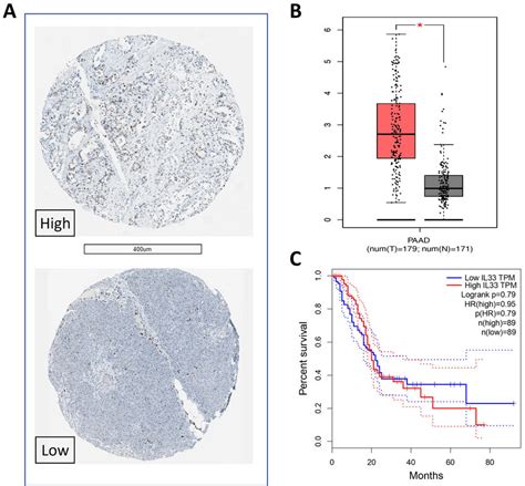 Il 33 Expression And Outcome In Pdac A Representative Images Showing