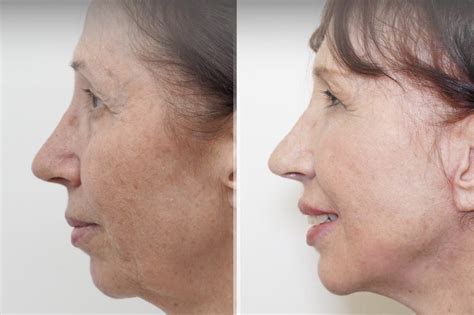 Gallery Face Dr Glancey Clinics