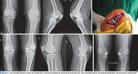 Figure 1 From Outcome Of Unicompartmental Knee Arthroplasty In