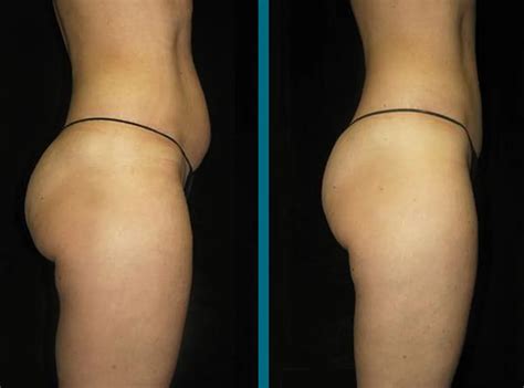 Pics Are After First Contour Light Session