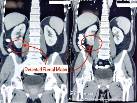 Partial Nephrectomy For Small Renal Tumour At Institute Of Urology Jaipur