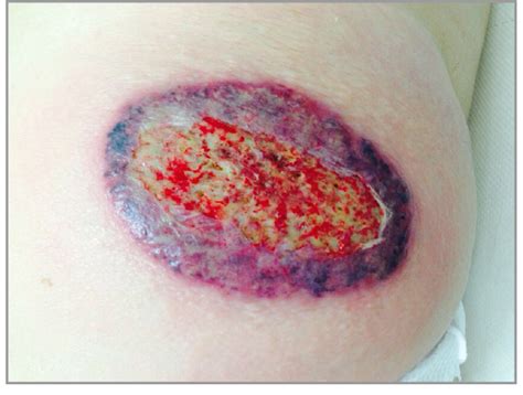 Pyoderma Gangrenosum With Inflammatory Livid Border Download Scientific Diagram