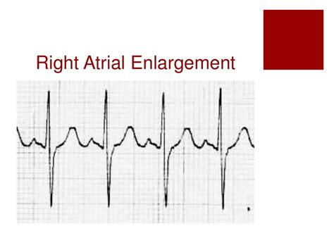 Systematic Ecg Interpretation