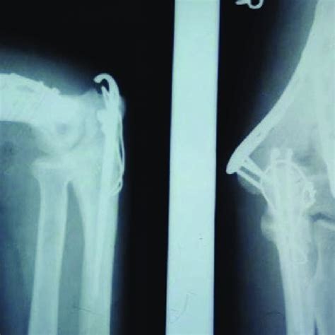 Case 1 Transolecranon Approach Range Of Motion At The Last Follow Up Download Scientific