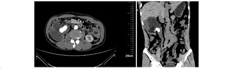 Abdominal Ct Demonstrated Significant Dilatation Of The Right Renal