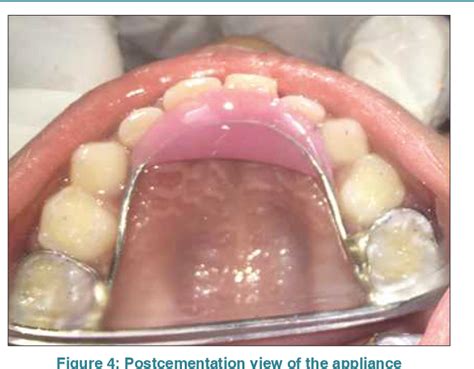 Figure From Esthetic Rehabilitation For Premature Loss Of Primary Anterior Teeth Semantic