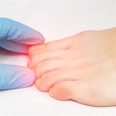 Understanding Toe And Metatarsal Fractures Causes Symptoms And