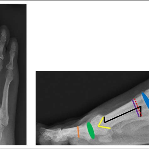 Traditional Radiographic Classification Of Hallux Valgus Deformity