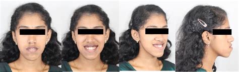 Treatment Of A Skeletal Class Iii Case With Conventional Orthognathic