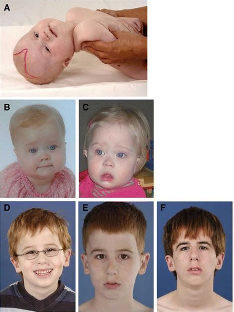 Zellweger Syndrome Causes Symptoms Diagnosis Treatment And Life Expectancy