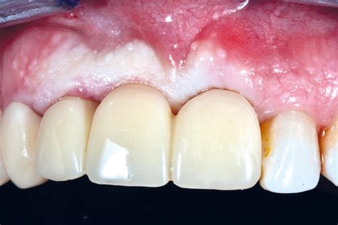 Socket Preservation Using Cerabone® And Straumann® Emdogain® Botiss