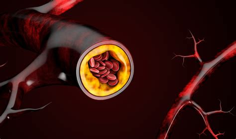 Aterosclerose sintomas causas e tratamentos Cirurgião Vascular em Nova Lima Clínica