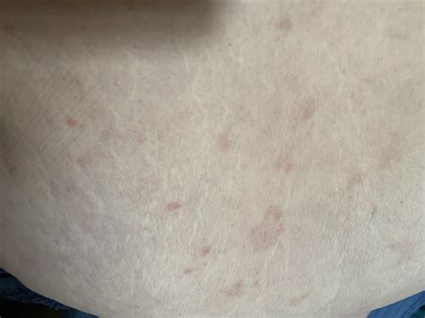 F35 Non Itchy Rash On Torso Any Idea What It Is I First Noticed A Few