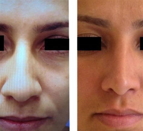 Bulbous Nose Can Be Corrected Rhinoplasty Cost Pics Reviews Qanda