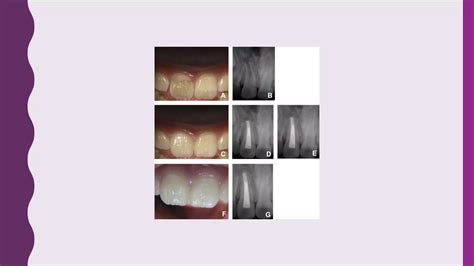 Apexogenesis And Apexification Pptx Dental Health Diseases And