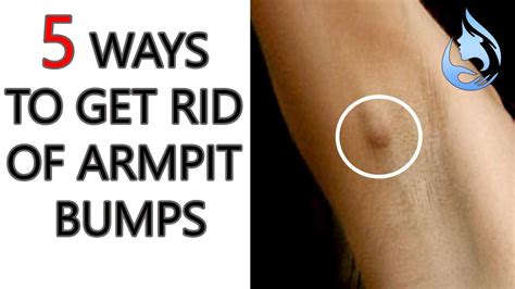 Why Am I Getting Bumps On My Armpits Printable Templates Protal