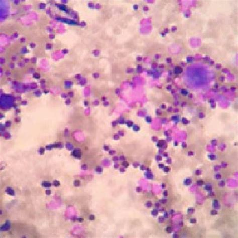 Bone Marrow Aspirate Showing Plenty Of Megakaryocytes Download