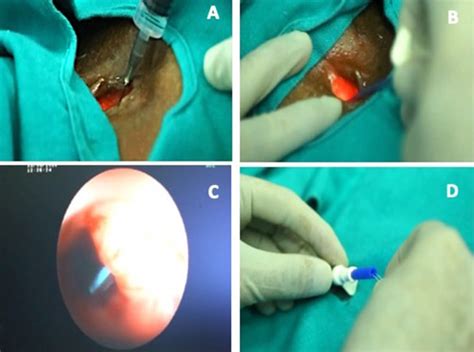 Tracheo Esophageal Prosthesis Insertion Under Endoscopic Guidance And
