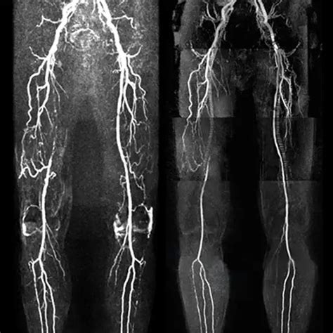 Mr Venography Left Lower Limb With Contrast Medintu