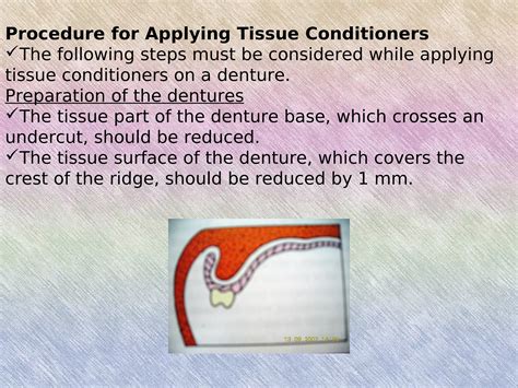 Tissue Conditioners Pdf