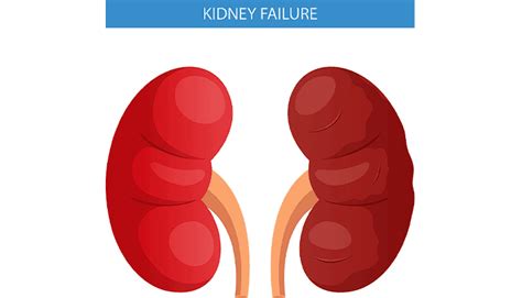 End Stage Renal Disease Causes Symptoms And Treatment Options