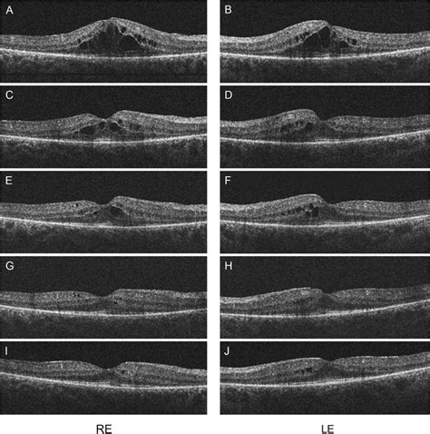 Oct Scans Of The Macula Of Both Eyes After 4 Series Of Tac Treatment